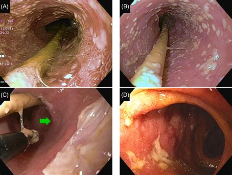 Inflammatory Bowel Disease Associated Digestive Disorders Clinical Tree