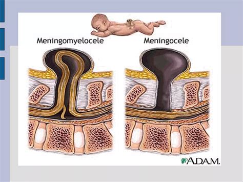 Spina Bifida And Open Neural Tube Defects Ppt