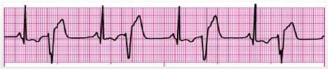 Cardiac Conduction Flashcards Quizlet