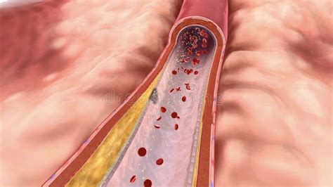 In Hyperlipidemia Excess Lipids Can Build Up On Artery Walls An Stock