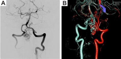 Spinal Angiography In A Cervical Intramedullary Avm A Ap Projection 2