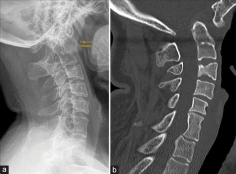 Atlanto Occipital Assimilation A Pictorial Review Of A Commonly Missed