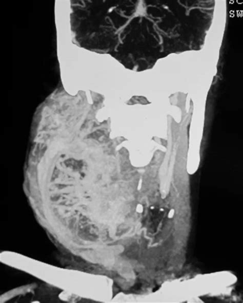 Lateral Skull Base Surgery Giant Glomus Jugulare Tumors