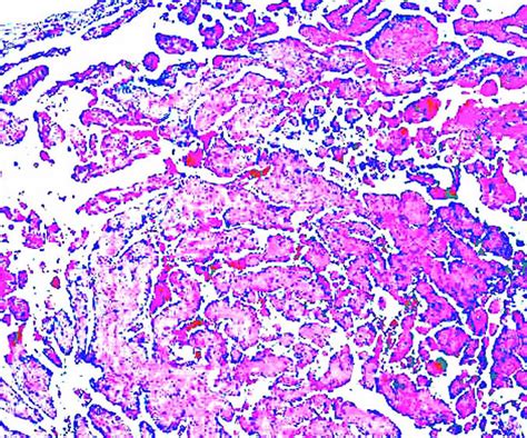 Papillary Hyperplasia