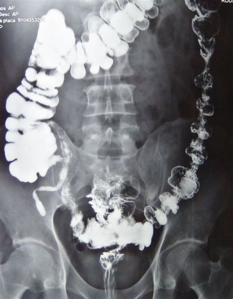Endoscopia Y Cirugía Digestiva Radiografia De Colon Por Enema De Doble