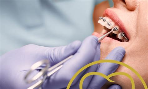 Is Getting Braces Really That Bad We Say Absolutely Not Welcome To