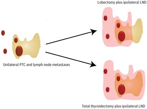 Kevin Higgins On Linkedin Lobectomy Vs Total Thyroidectomy With Ipsilateral Lnd For N1b…
