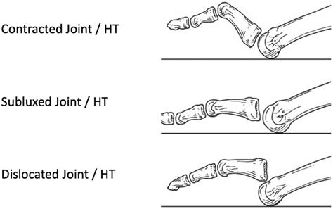 Direct Plantar Plate Repair For Second Metatarsal Phalangeal Joint
