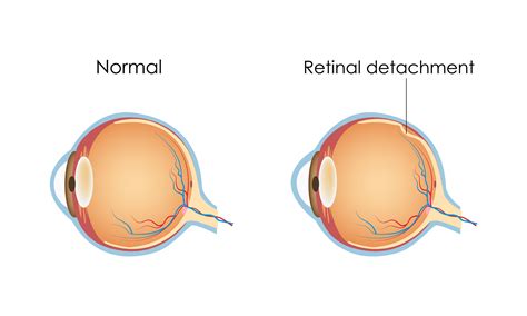 Retinal Detachment Canadian Association Of Optometrists