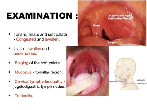 Quinsy Peritonsillar Abscess Ppt