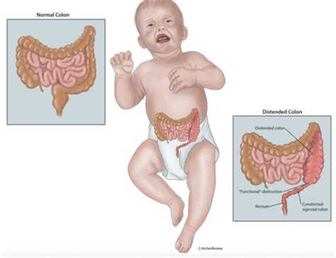 Hirschsprung Flashcards Quizlet