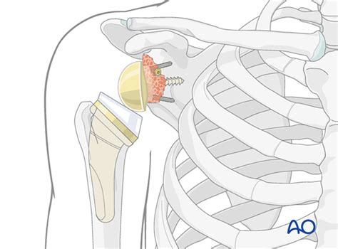 Revision Of A Hybrid Glenoid Component For Glenoid Implant Loose Poor