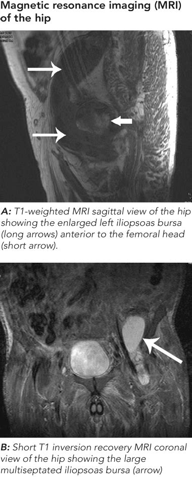 Joined At The Hip Rheumatoid Arthritis And Tuberculosis The Medical