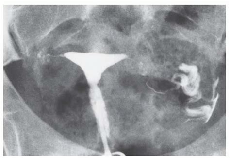 Salpingitis Laparoscopy