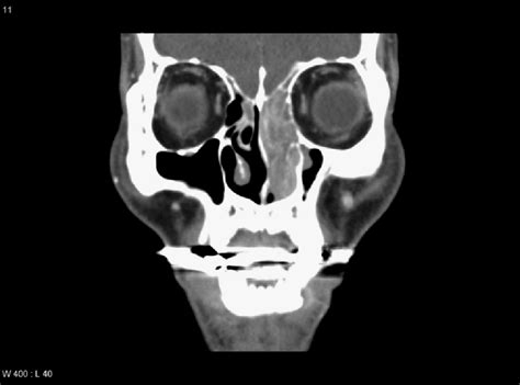 Ct Scan With Enhancement Ct Shows Anterior Ethmoidal Sinus Inferior Download Scientific