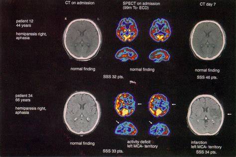 40 Best Images About Tia Transient Ischemic Attack On Pinterest