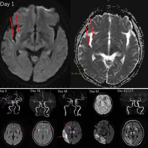 The Comparative Findings Of The Brain Mri The Dwi Revealed A High