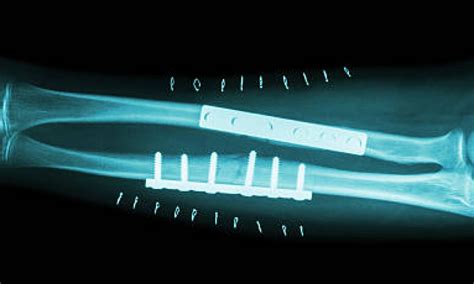 Bone Plating System Market Growth Advanced Orthopedic Surgical Solutions