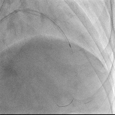Rotational Atherectomy With 125mm Burr To Mid Lad Download
