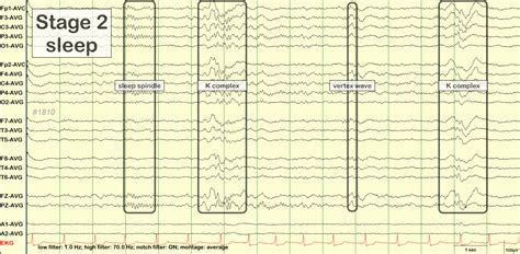 K Complex Alchetron The Free Social Encyclopedia