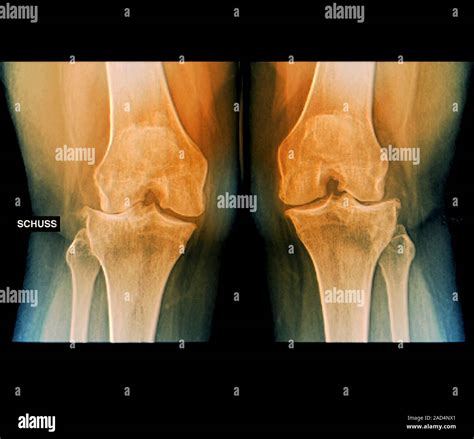 Varus Deformity In Osteoarthritis X Ray Of A Section Through The Knees