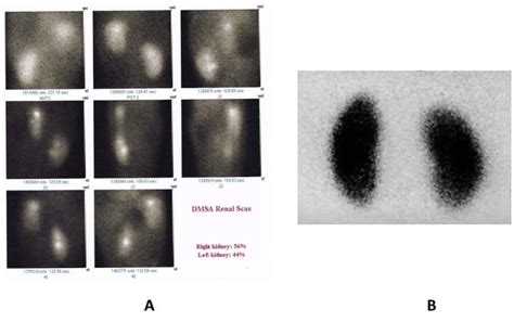 Tc99m Dmsa Scan Demonstrated Normal Findings No Defect Was Reported Download Scientific