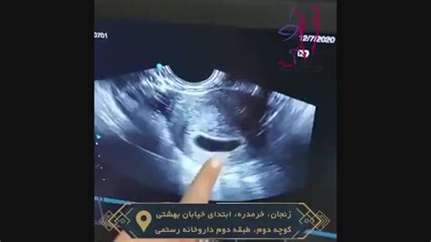 فیلم واقعی از سونوگرافی جنین عد از 2 سال ناباروری نماشا