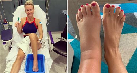 Womans Horrific Injury From Stonefish Venom