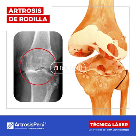 Artrosis De Rodilla Fundación Preventis