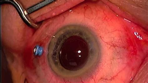 Vitrectomy For Erm Youtube