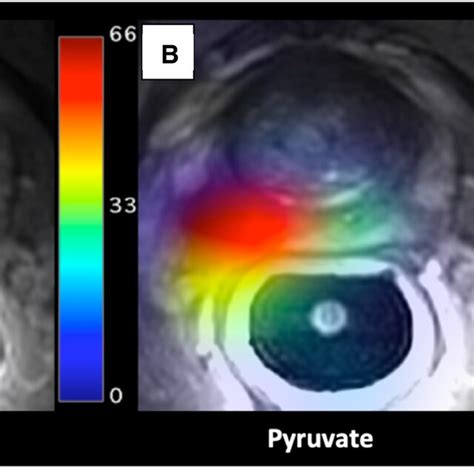 Hyperpolarised 1‐¹³c‐pyruvate‐mri Metabolite Maps In Mri‐ And