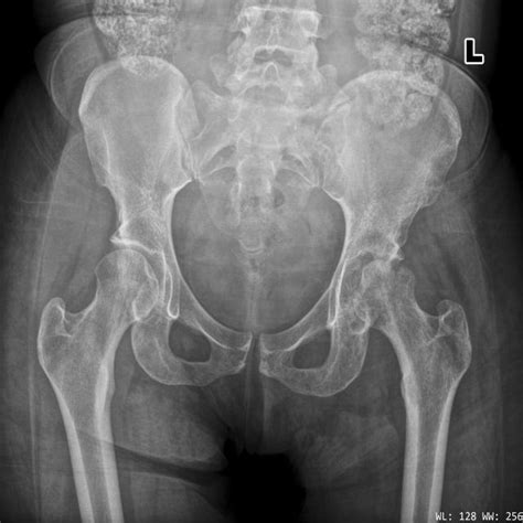 Bone Instance Segmentation Model By Moke