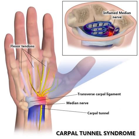 Median Nerve Carpal Tunnel
