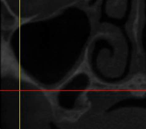 Cbct Image Showing The Presence Of Sinus Septum Download Scientific