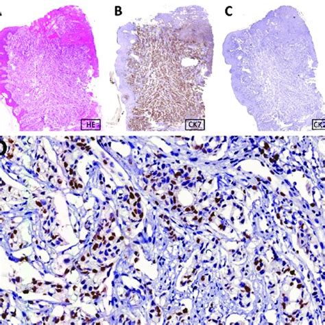 Immunohistochemical Features Of The Lesion A He Stain In Low