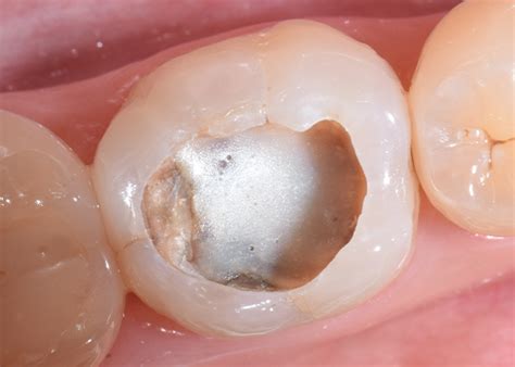 The Modern Role Of Liners In Adhesive Dentistry Solventum