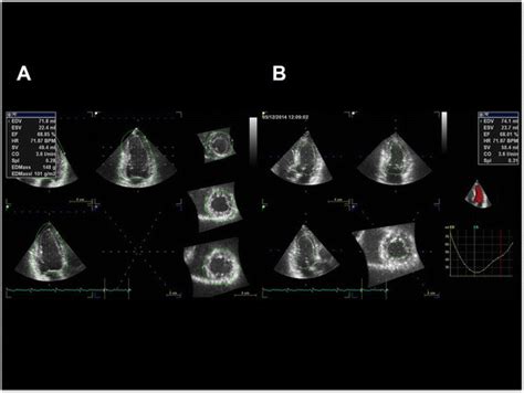 Examples Of Calculation Of Left Ventricular Mass A And Volumes B By