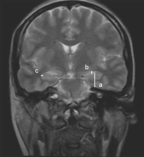 Representative Images Including Measurements Of Hippocampal Choroid