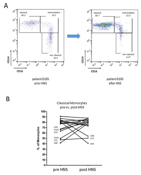 Dynamics Of Circulating Cd14 Cd16 Monocyte Subsets In Obstructive Sleep Apnea Syndrome Patients