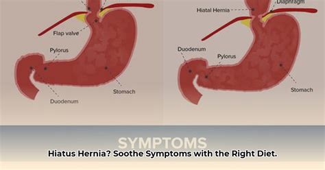 Hiatus Hernia Symptoms And Diet Nhs Advice And Management Chaztin
