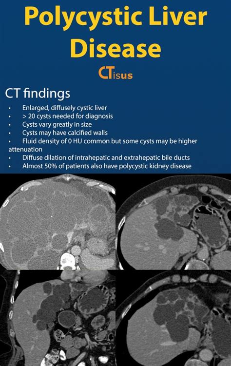 Ctisus On Linkedin Polycystic Liver Disease Ct Findings Gdw9qkvp