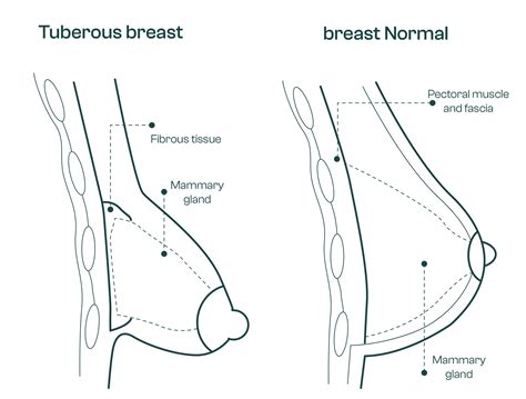 Tuberous Breasts How To Identify Them How They Are Corrected