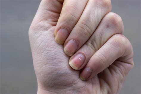 White Spots On Nails What Deficiency Causes White Spots On Nails