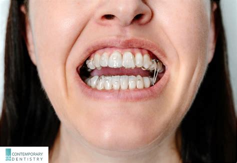 Can Invisalign Fix Overbite Rochester Smile Guide