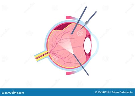 Vitrectomy Surgical Poster Vector Illustration