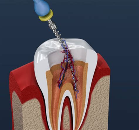 Endodontics Precision Smile Dental Clinic