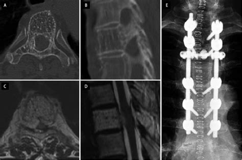 Vertebral Hemangioma — The Current Radiation Therapy Perspective