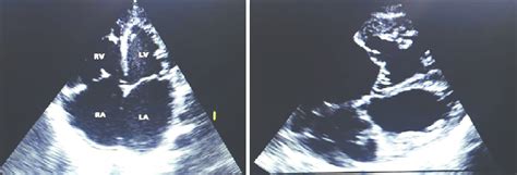 A And B Two‑dimensional Echocardiogram Showing Excessive