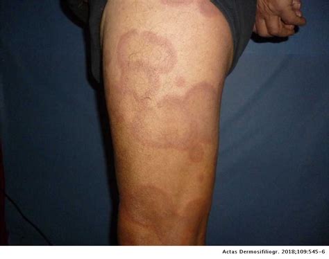 Annular And Polycyclic Lesions On The Lower Limbs Actas Dermo