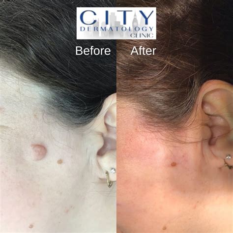 Before And After Photos Mole Removals